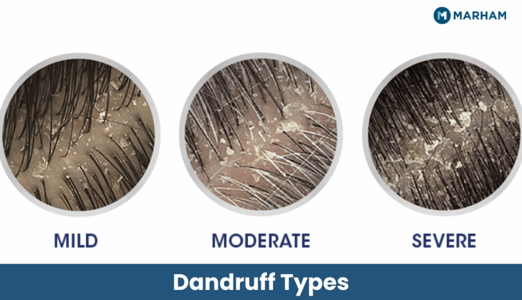 Dandruff Treatment: Causes, Symptoms & Home Remedies
