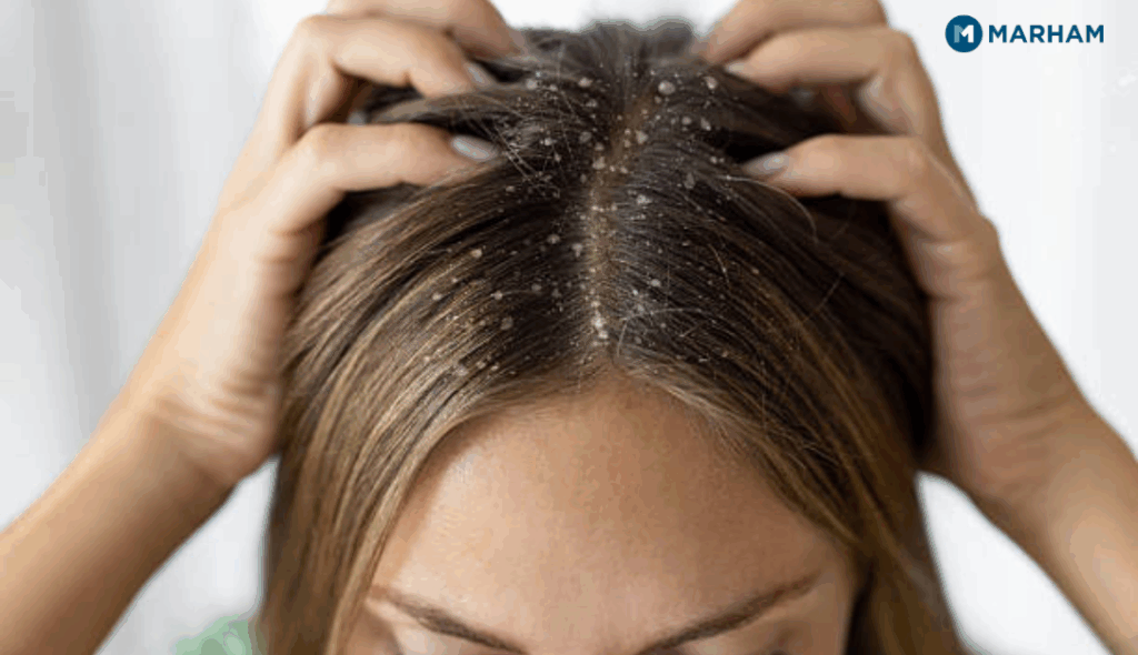Dandruff Treatment: Causes, Symptoms & Home Remedies