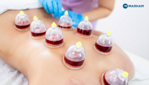 8 Incredible Hijama Benefits | The Ultimate Cupping Guide